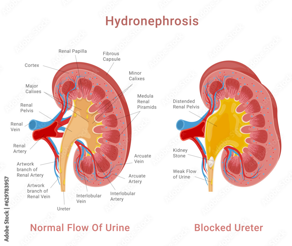 Kidney stone normal flow of urine and blocked ureter medical scheme ...