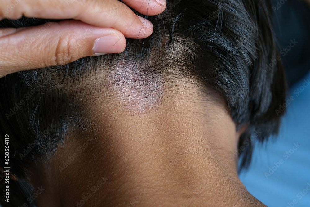 Стоковое фото «Closed up of ringworm (tinea) on head of Asian girl ...