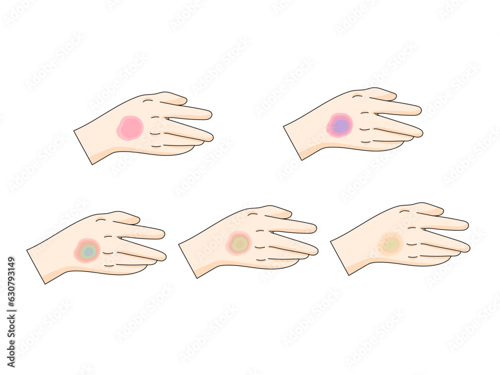bruise stages diagram schematic vector illustration. Medical science ...