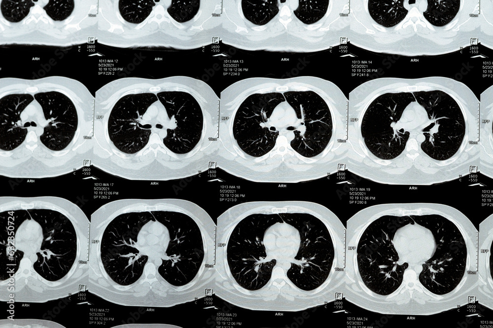 Stock-Foto „Multi slice CT scan of the chest showing normal study ...