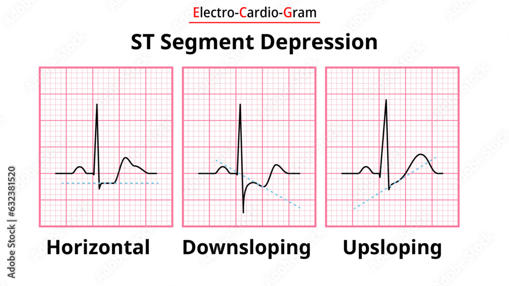 Vector De Stock ECG Morphology Of ST Segment Depression Horizontal Vector De Stock ECG Morphology Of ST Segment Depression Horizontal