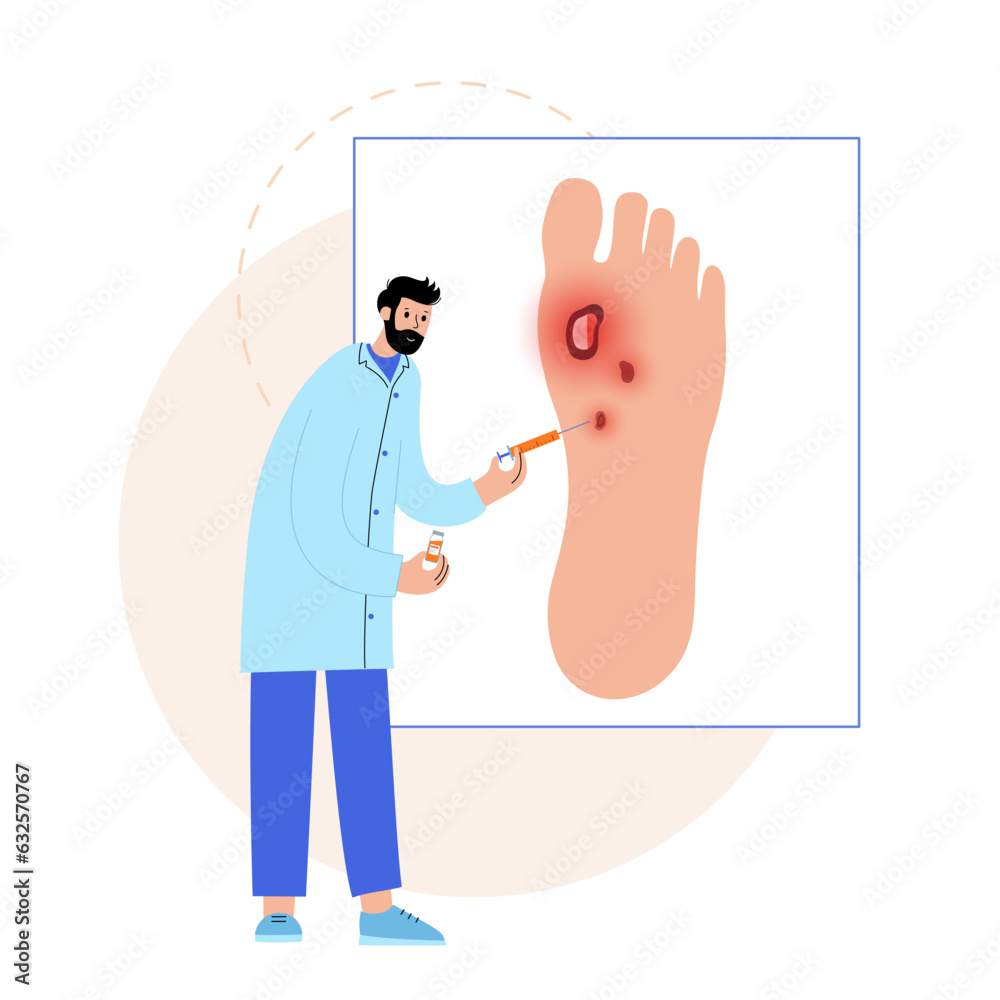Diabetic Foot Ulcers Stock Vector | Adobe Stock
