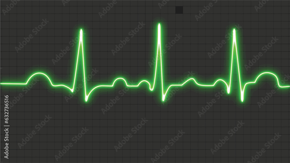 ECG paper with a normal sinus rhythm is a vector medical illustration ...