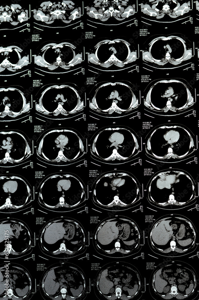 Stock-Foto „Multi slice CT scan of the chest showing normal study ...