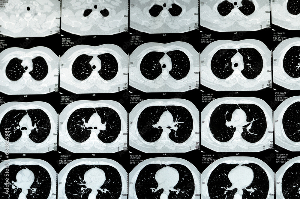 Multi slice CT scan of the chest showing normal study, normal ...