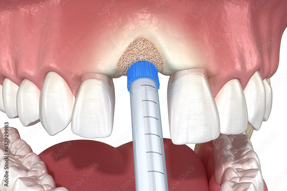 Bone grafting augmentation, socket preservation, tooth implantation ...