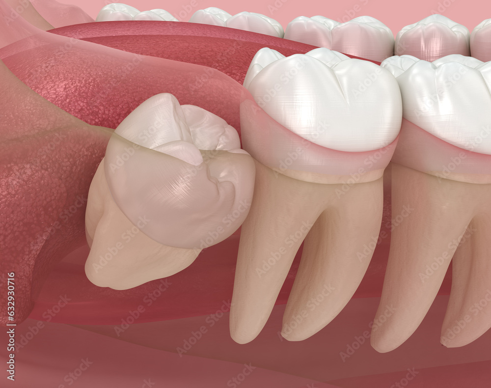 Abnormal position of wisdom teeth. Medically accurate tooth 3D ...