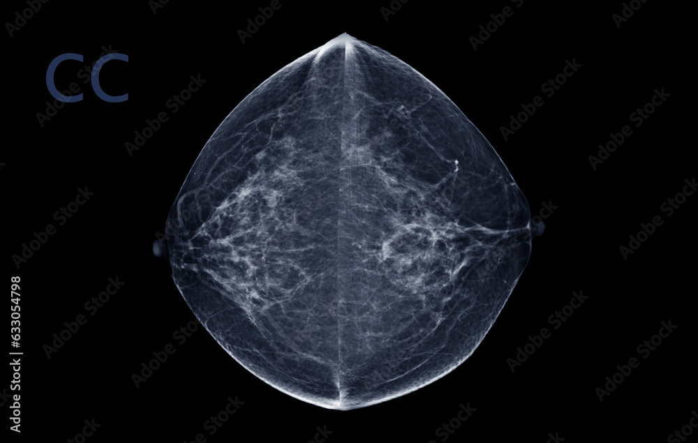 X-ray Digital Mammogram of Both side CC view . Stock Illustration ...