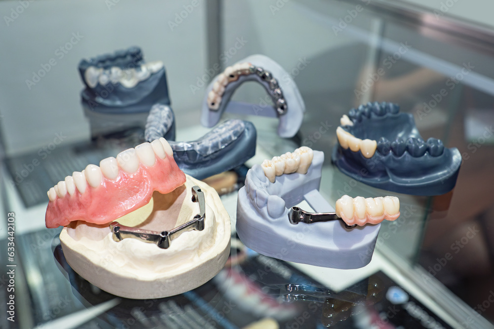 Dental implants. Dentist design set. Models of dentures. Implants for ...
