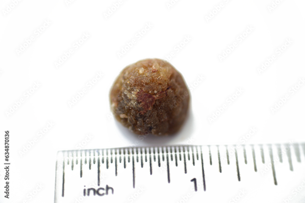 ภาพถ่าย Stock Size of gallstone removed surgically after laparoscopic ...