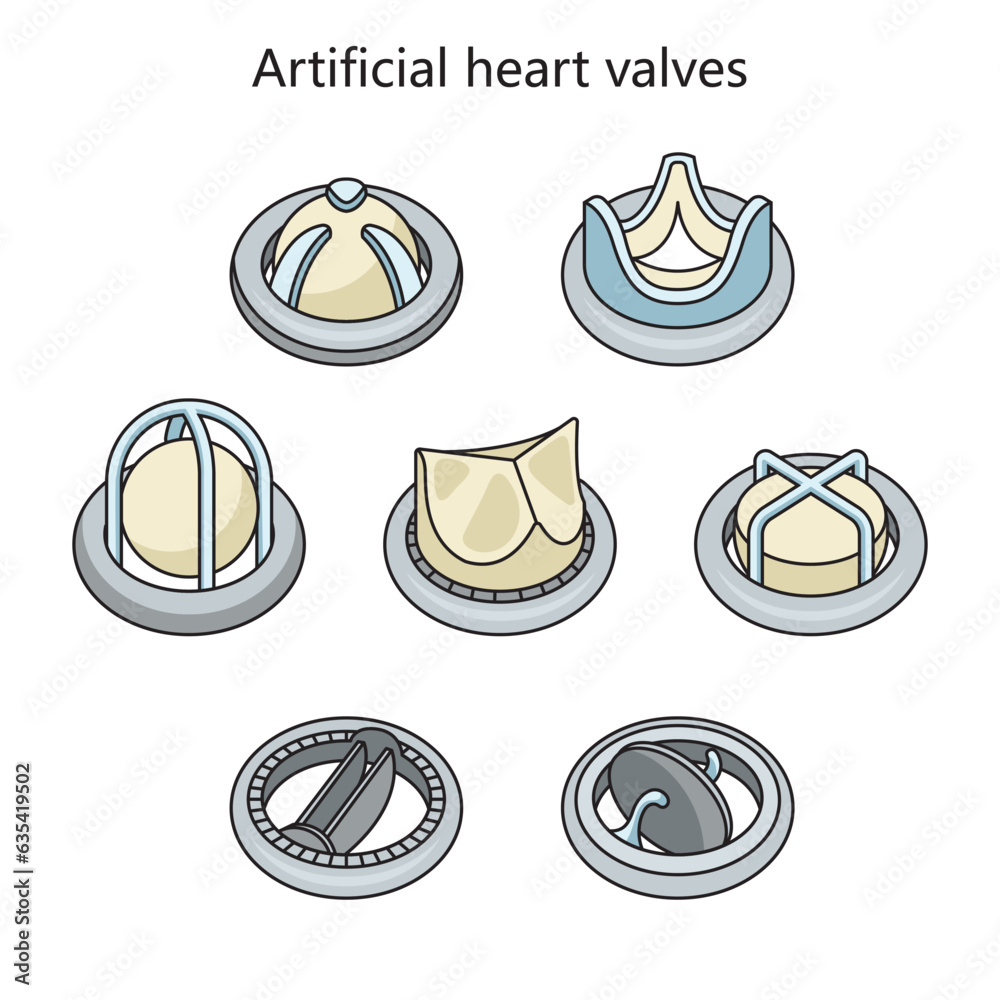Artificial heart valve implant in human heart diagram schematic vector ...