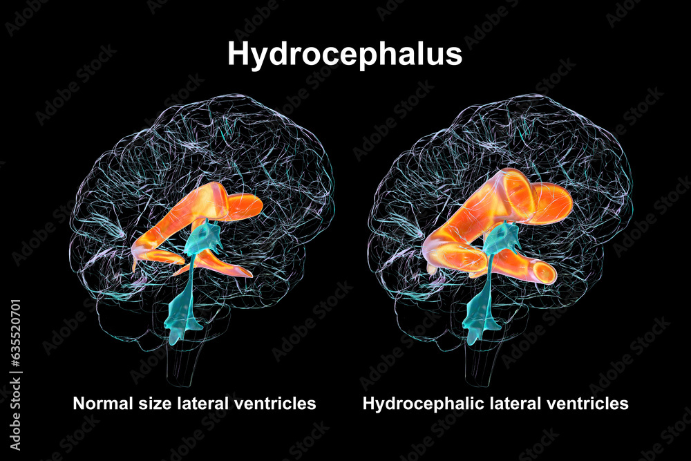 Enlarged lateral ventricles of the child brain and normal ventricular ...