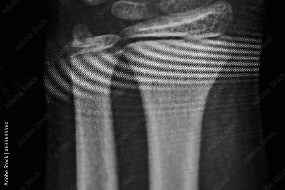 x-ray of the hands, detail of the phalanges and joints,trapeze,scaphoid ...