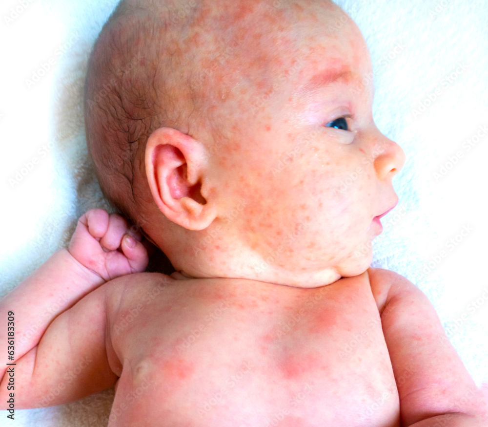 baby allergy skin. child dermatitis symptom problem rash. suffering ...