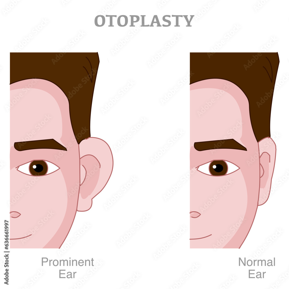 Prominent ear, otoplasty correction surgery. Plastic operation. Male ...