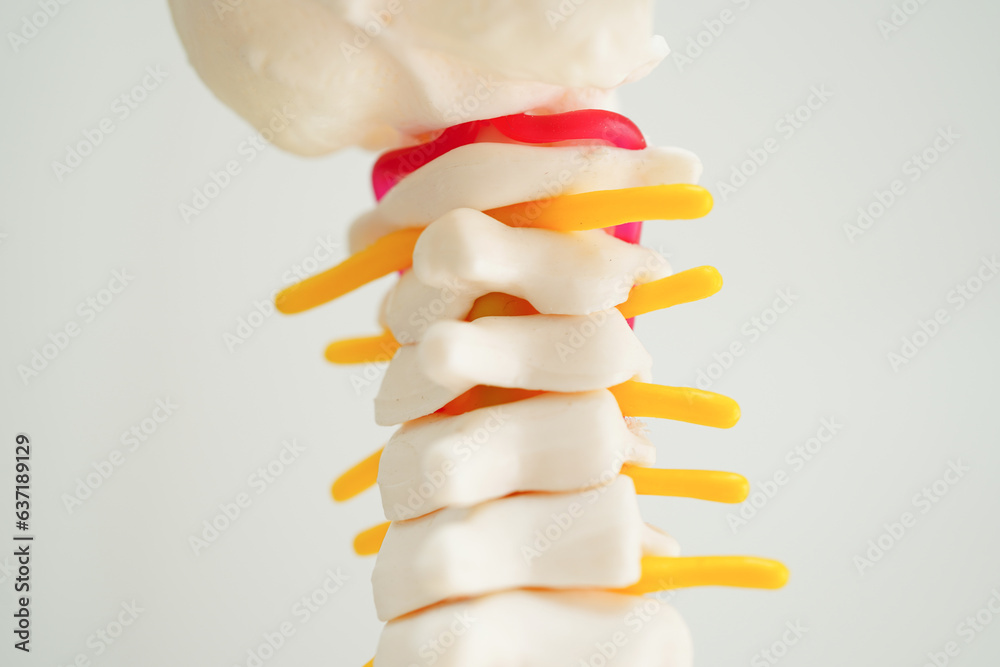 Spinal nerve and bone, Lumbar spine displaced herniated disc fragment ...