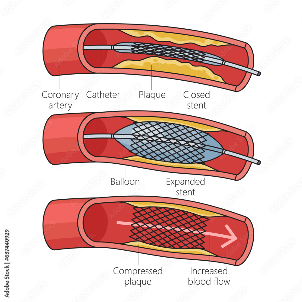 Diagram of coronary stent placement schematic vector illustration ...