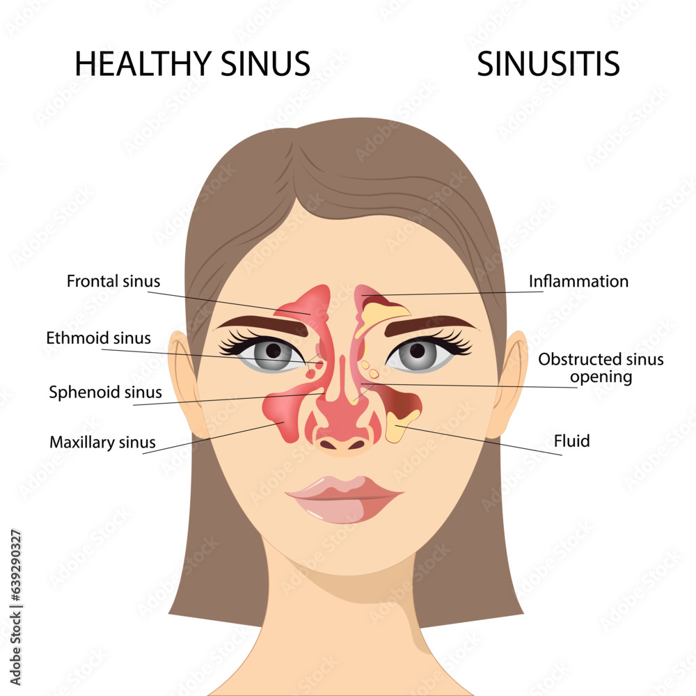 Sinusitis, Female face with inflammation of the mucous membrane of the ...