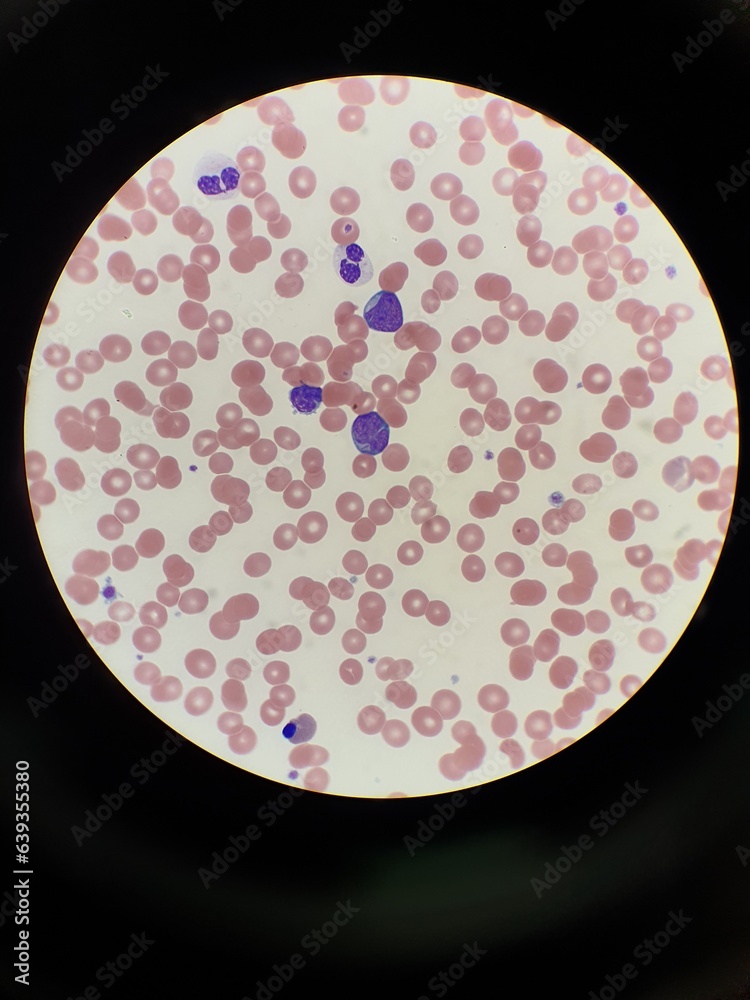 Microscopy of red blood cells & white blood cells in patient with acute ...