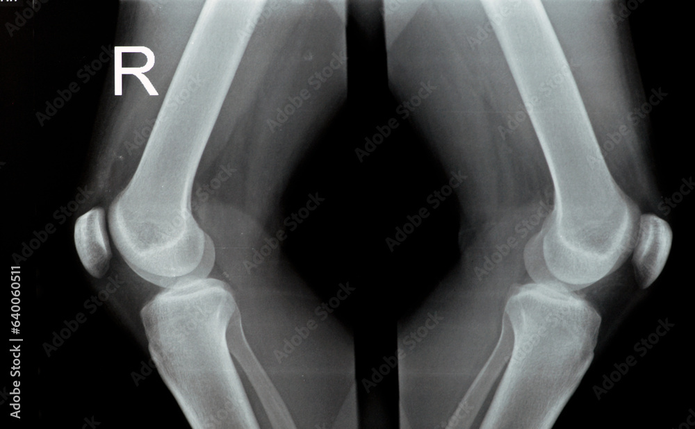 Foto de Stock Plain X ray of both right and left knee joints with lower ...