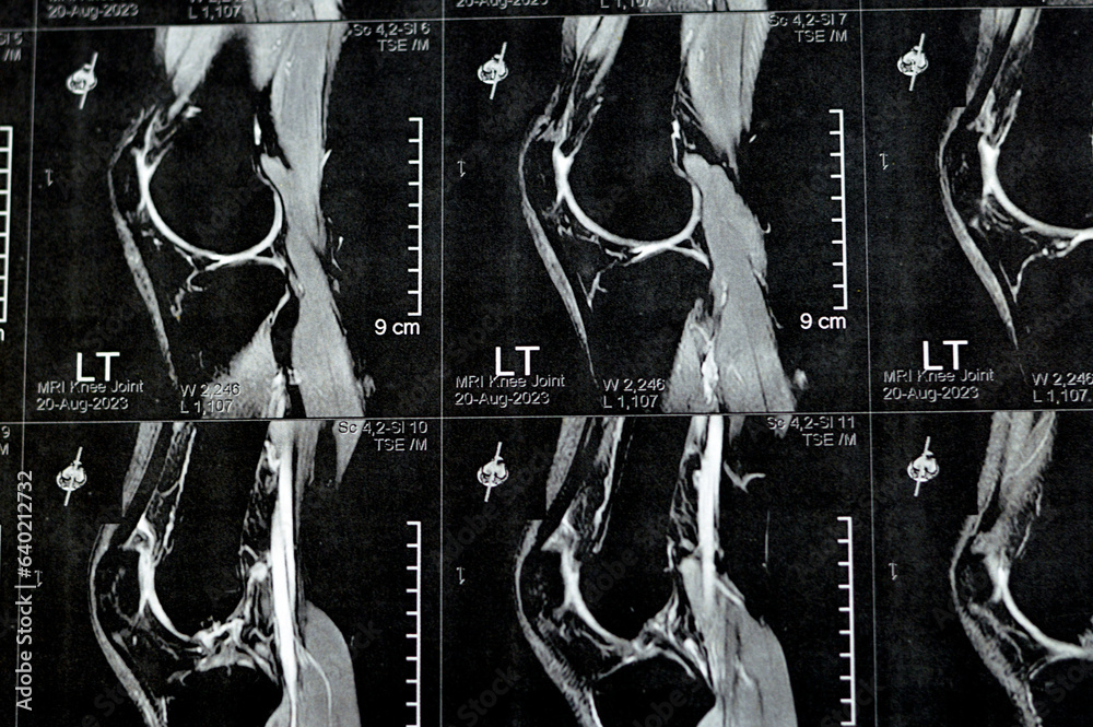 MRI of left knee joint showing minimal joint effusion, PHMM Posterior ...