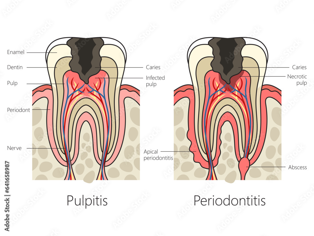 Pulpitis and periodontitis in human teeth diagram schematic vector ...