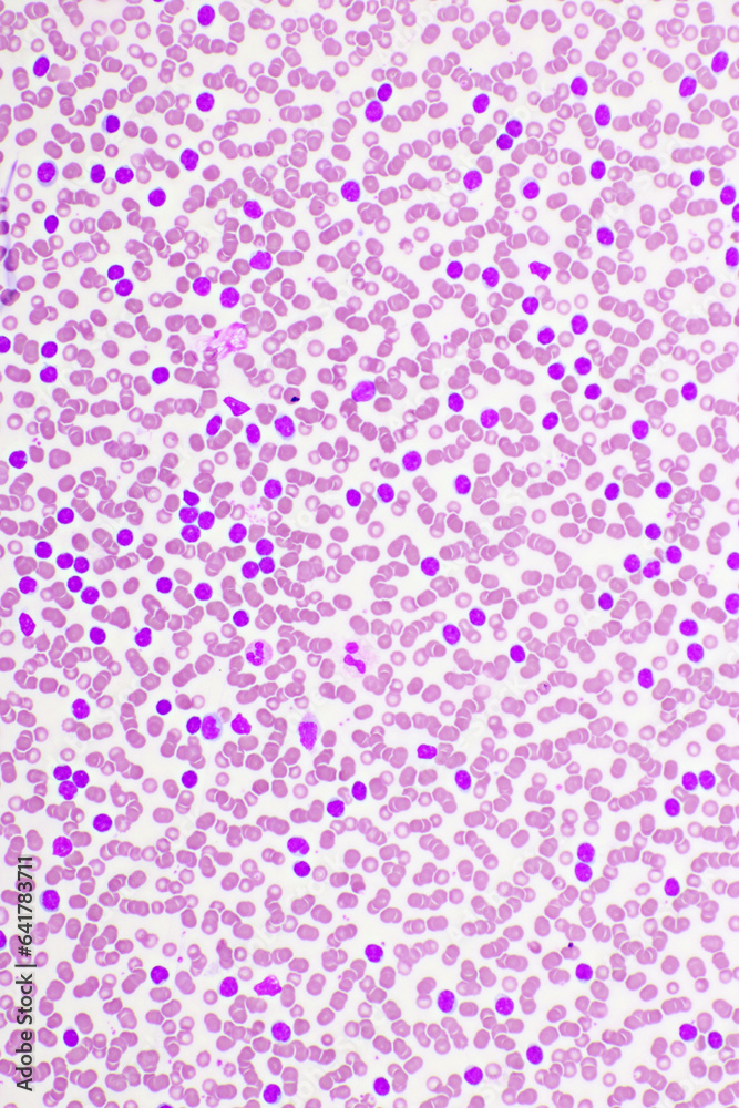 Picture of acute lymphocytic leukemia or ALL cells in blood smear ...
