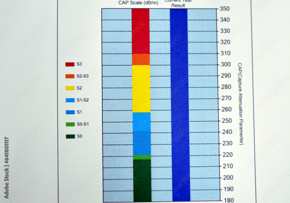 Fibroscan examination study of the liver revealed F2 for liver ...