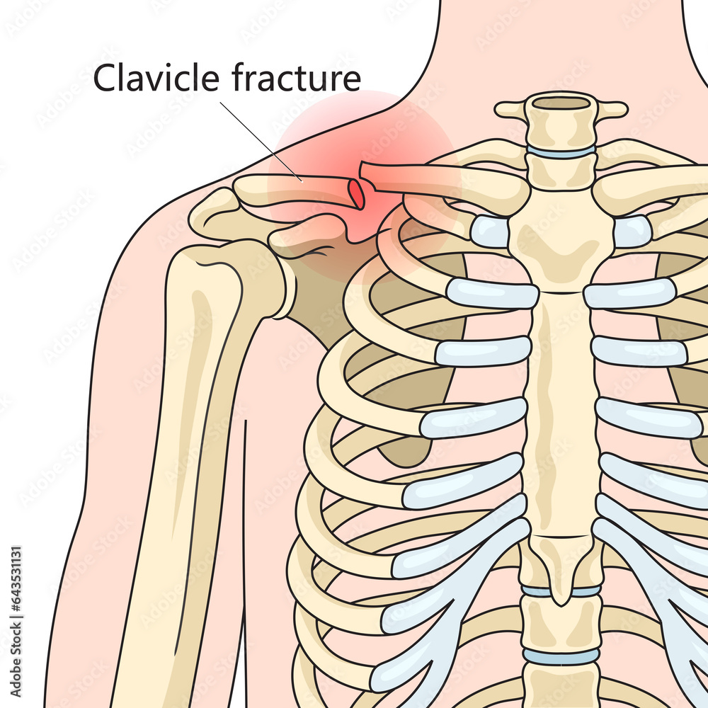 Clavicle fracture broken collarbone structure diagram schematic raster ...