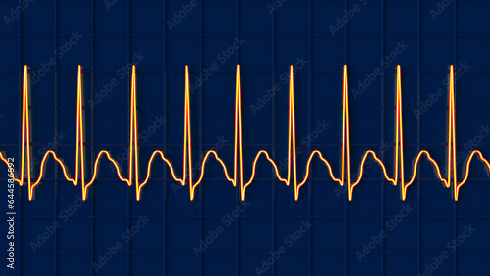 ECG in atrial flutter, 3D illustration Stock Illustration | Adobe Stock