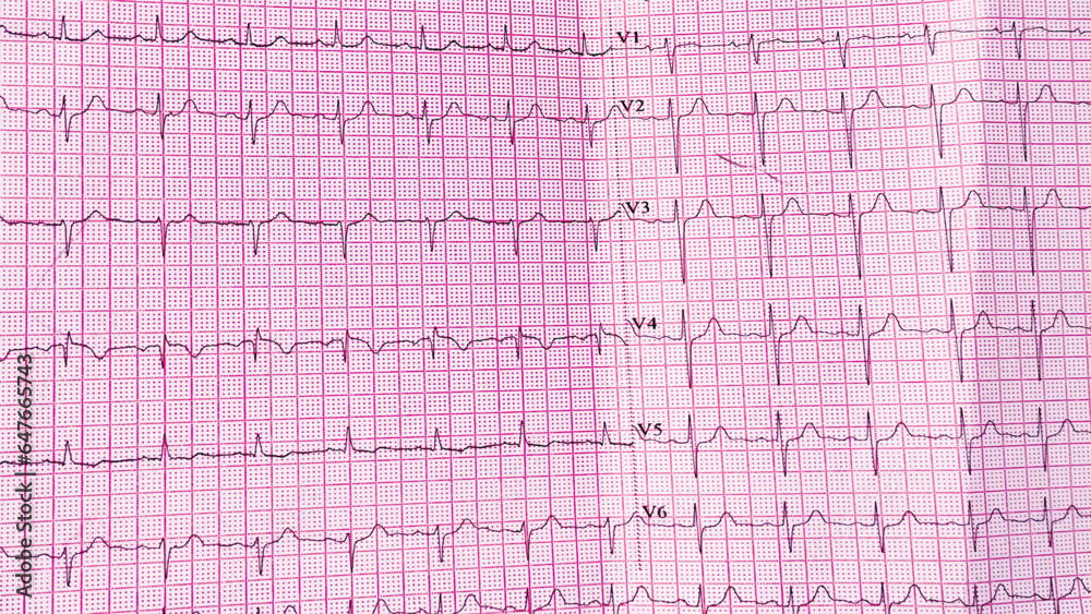 ekg heartbeat pulse rate red grid paper that shows sinus rhythm ...