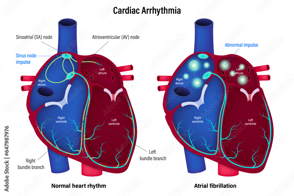 Cardiac Arrhythmia vector. Compare the differences between normal heart ...
