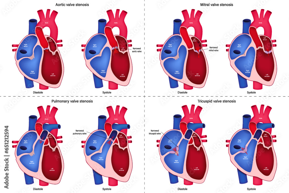 Heart valve disease vector. Cross section of human heart. Aortic stenosis, Mitral stenosis ...