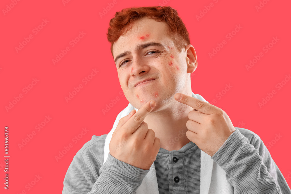 Teenage boy with acne squishing pimples on red background Stock Photo ...