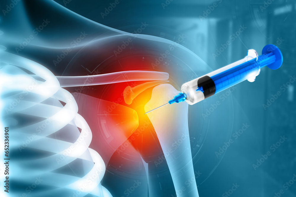 ภาพประกอบ Stock Shoulder Joint Injection, shoulder joint pain, x-ray ...
