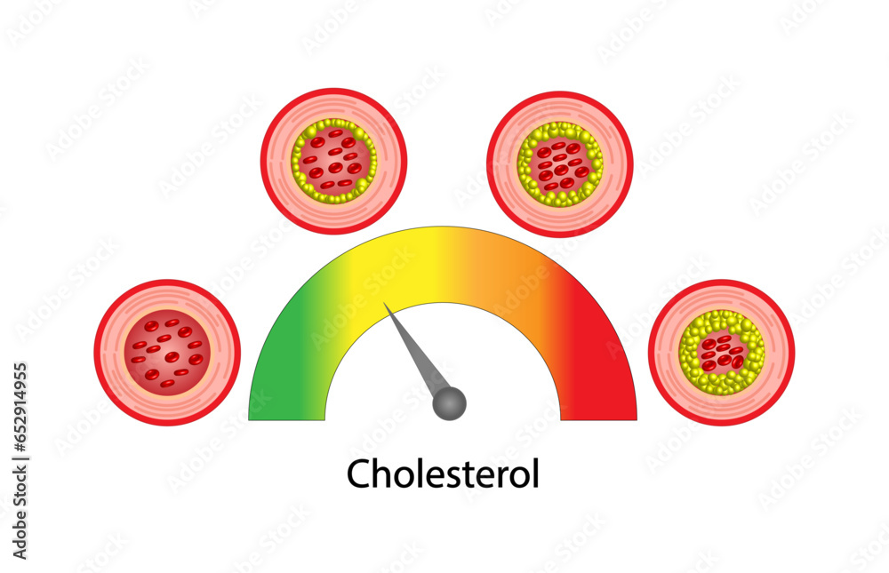 Hyperlipidemia, Atherosclerosis. cholesterol chart on white background ...