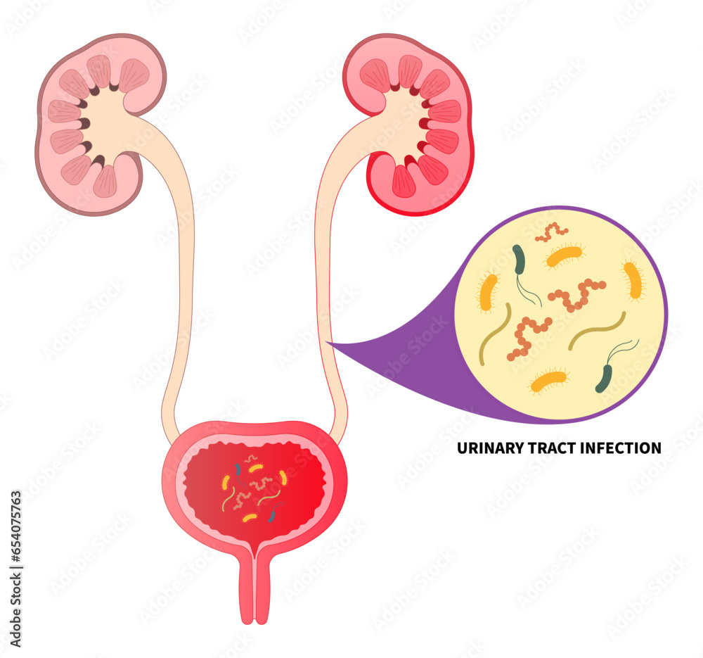 Bacteria infection of urinary tract with the E coli and C diff fungal ...
