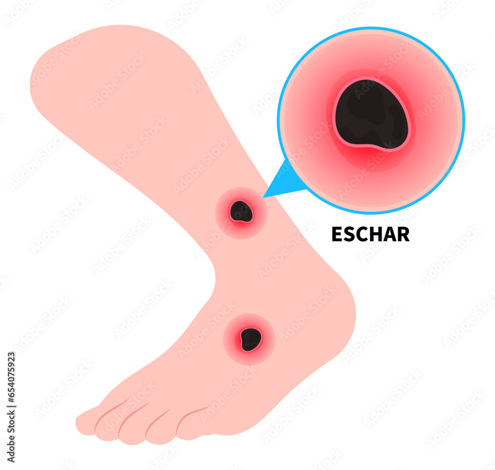 Foot leg wounds and skin infection with eschar or scrub typhus the ...