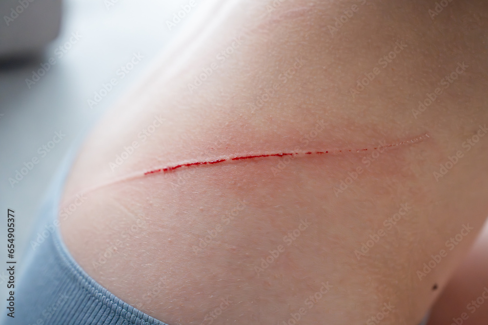 spray antiseptic on the wound on the child's back. disinfection of ...