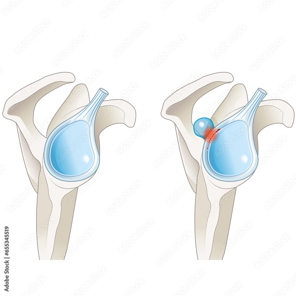 SLAP lesion paralabral cyst in the shoulder. Medically Illustration ...