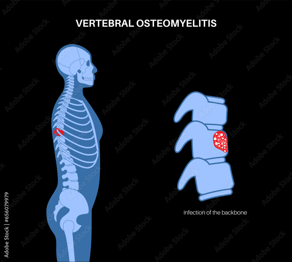 Vertebral osteomyelitis poster Stock Vector | Adobe Stock