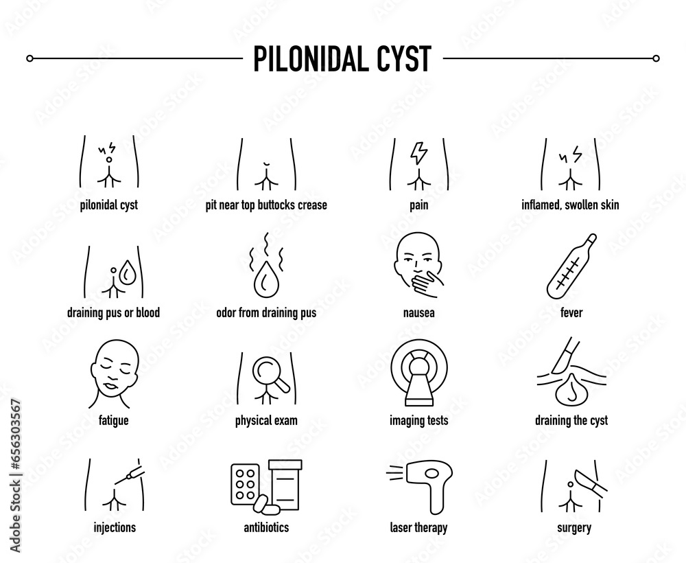 Pilonidal Cyst symptoms, diagnostic and treatment vector icons. Line ...