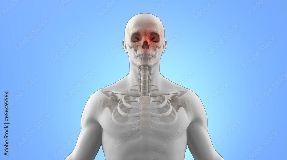 Human skeleton with orbital face fracture Stock Illustration | Adobe Stock