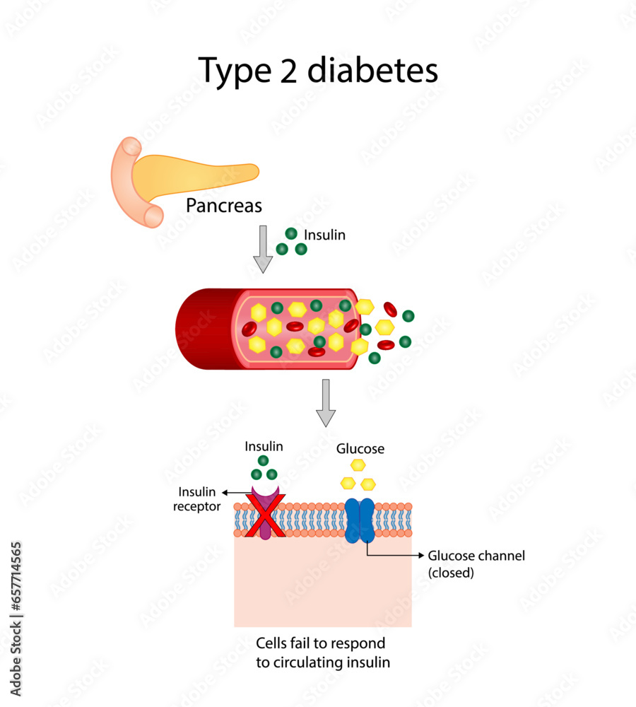 Diabetes mellitus type 2, cells fail to respond to insulin (Insulin ...