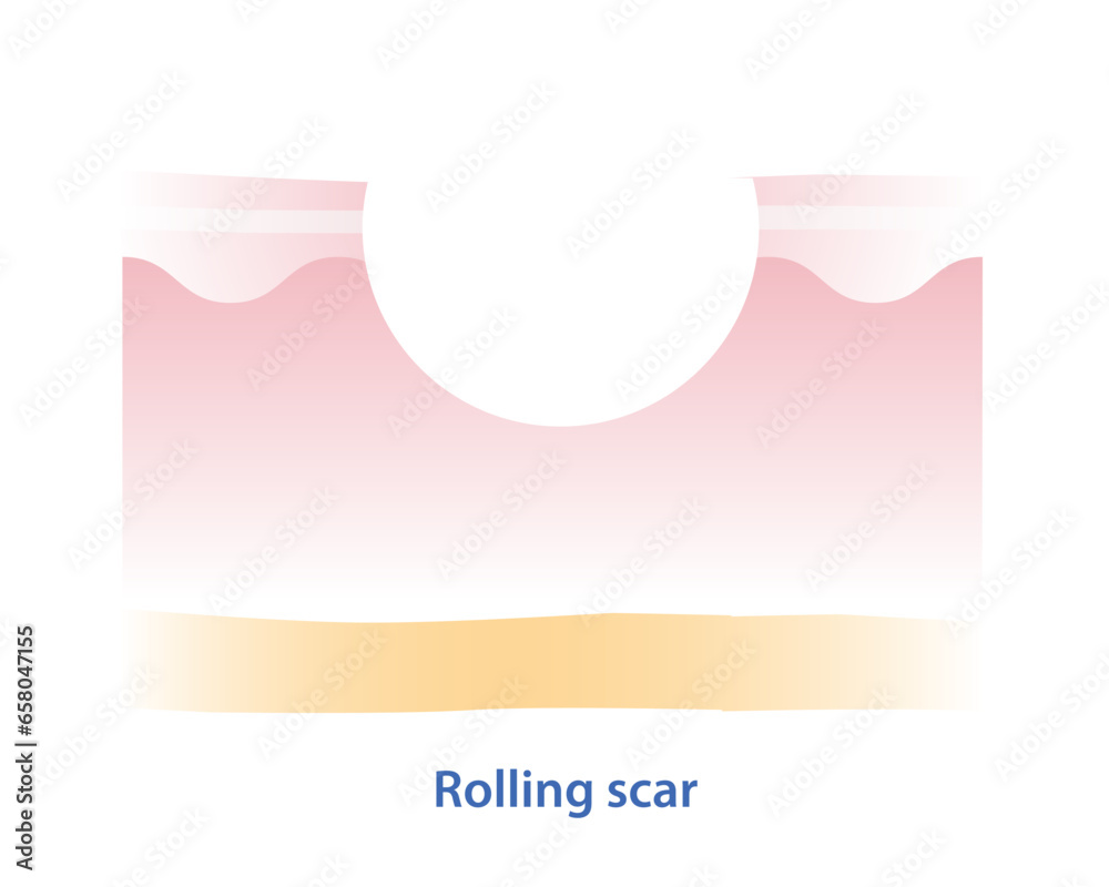 Cross section of rolling scar vector illustration isolated on white ...