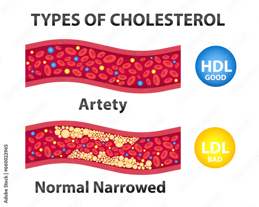 Types of cholesterol comparison with HDL and LDL lipoprotein. Labeled ...