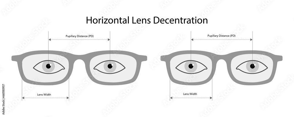 Horizontal Lens Decentration Pupillary distance measurement diagram Eye ...