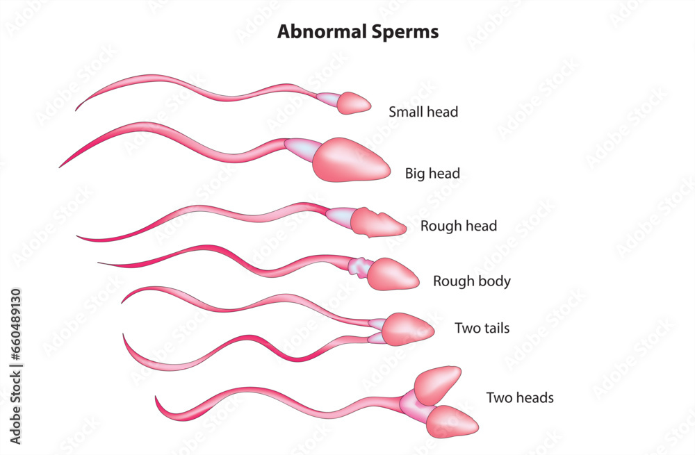 Biological Anatomy of Abnormal Sperms (classification of Abnormal sperm ...