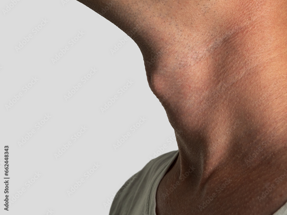 Anatomy of the laryngeal cartilage in men, Adam's apple in men ...