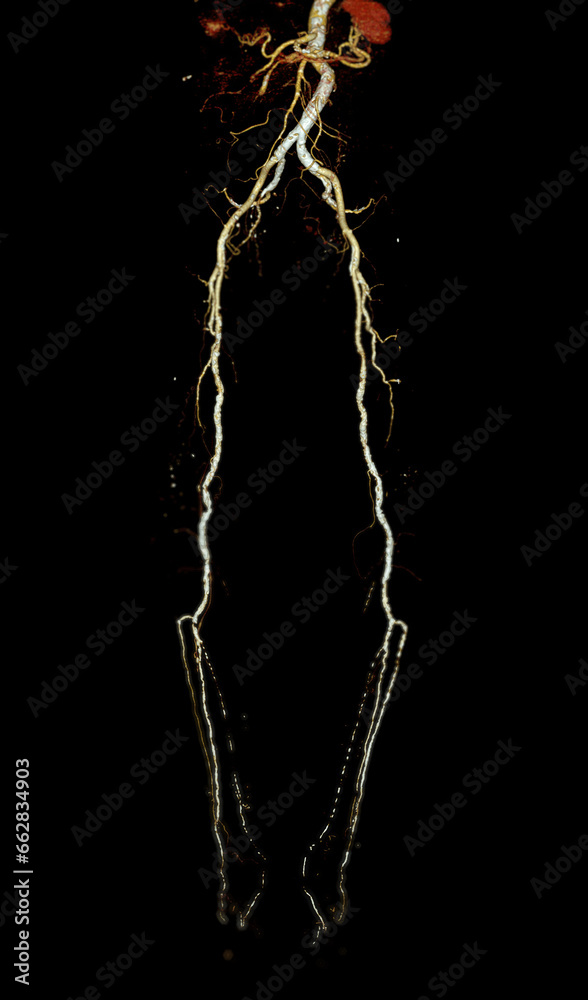 Стоковое фото «CTA femoral artery run off image of femoral artery for ...